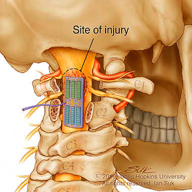Backs to the Future | Johns Hopkins Medicine