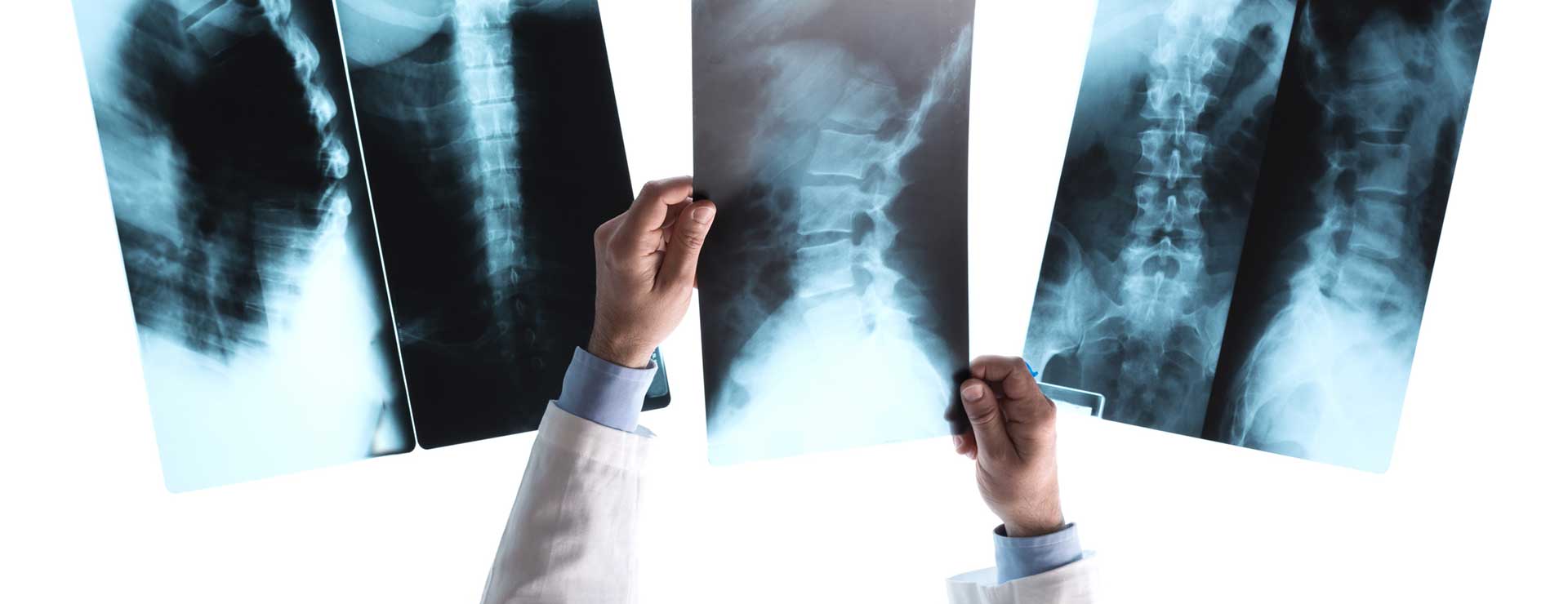 Ankylosing Spondylitis | Johns Hopkins Medicine