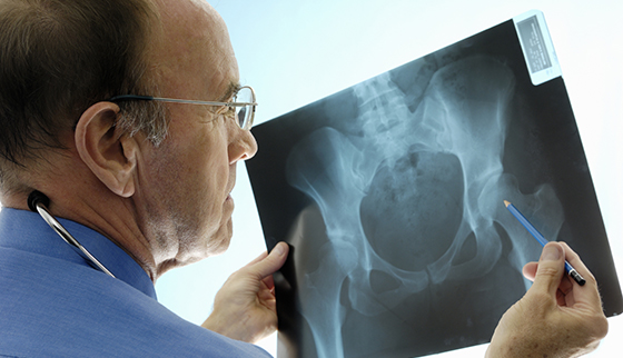 Avascular Necrosis | Johns Hopkins Medicine