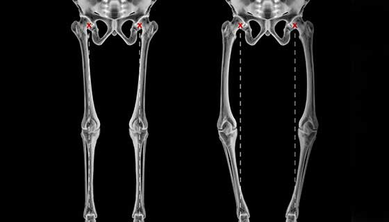 Cartilage Hair Hypoplasia | Johns Hopkins Medicine