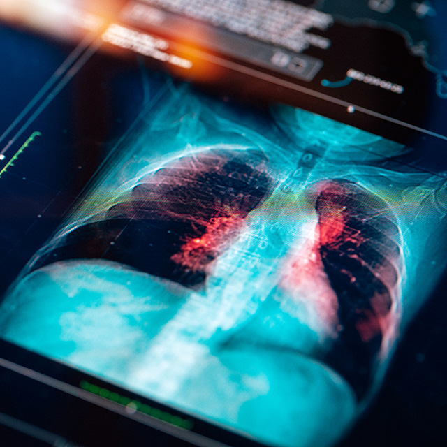 Restrictive Lung Disease | Johns Hopkins Medicine