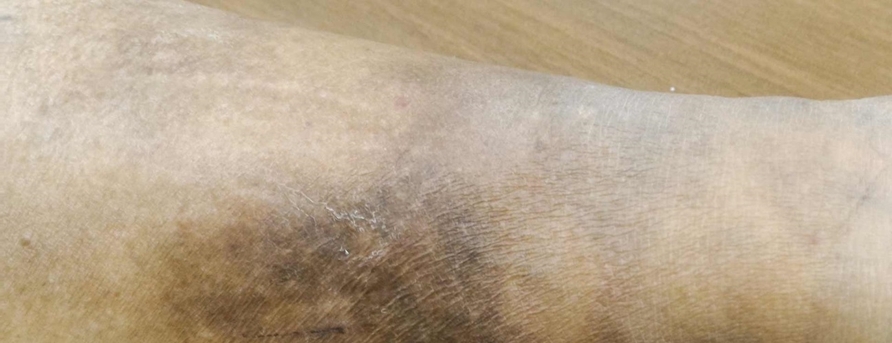 Cellulitis Johns Hopkins Medicine cellulitis-johns-hopkins-medicine
