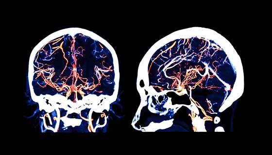 Microsurgical Clipping and Endovascular Coiling for Brain Aneurysm ...