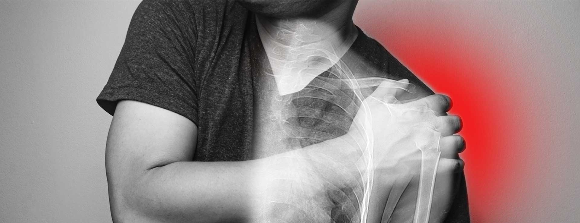 Total Shoulder Replacement | Johns Hopkins Medicine