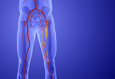 Femoral Popliteal Bypass Surgery | Johns Hopkins Medicine