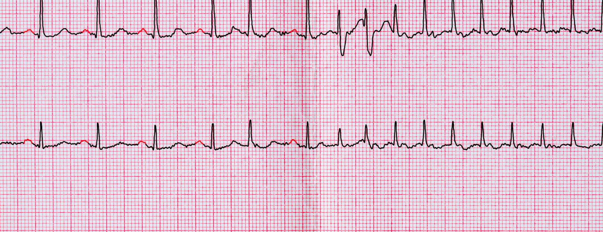 Heart Rhythms What s Normal Versus Cause For Concern Johns Hopkins Heart Rhythms What s Normal Versus Cause For Concern Johns Hopkins