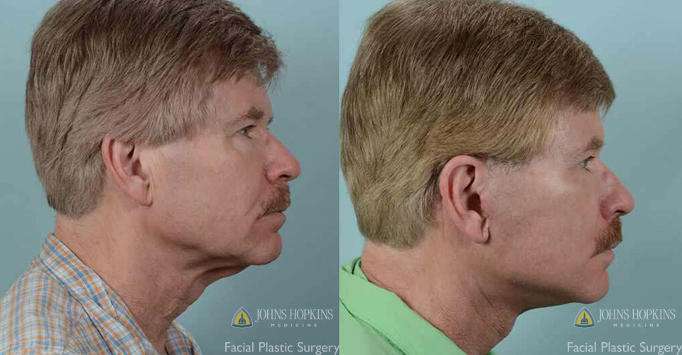 Neck Lift | Johns Hopkins Medicine