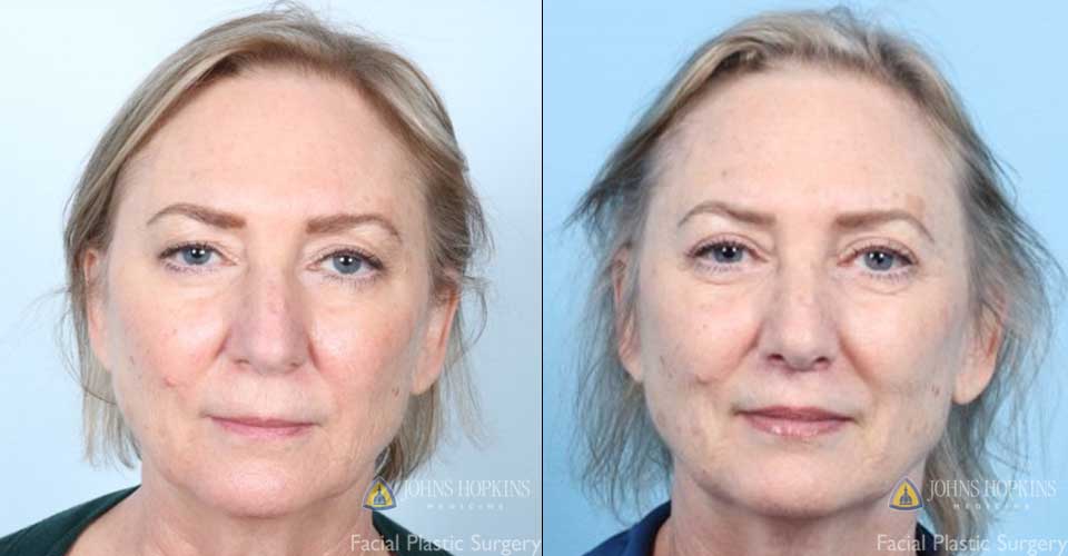 Eyelid lift | Johns Hopkins Medicine