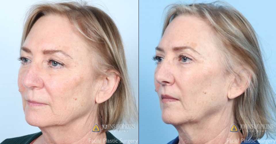 Eyelid lift | Johns Hopkins Medicine