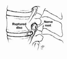 Degenerative Disc Disease | Johns Hopkins Medicine